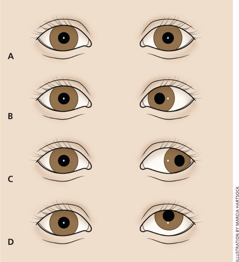Test de Hirschberg – Neuropediatoolkit
