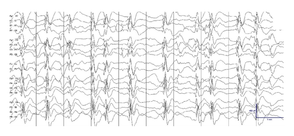 POCS – Neuropediatoolkit