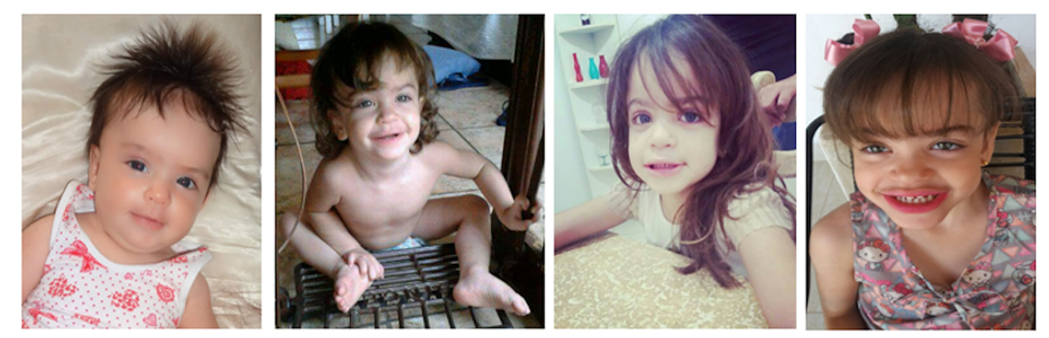 Facies tosca. – Neuropediatoolkit