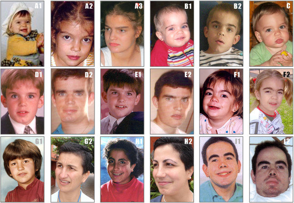 Facies tosca. – Neuropediatoolkit