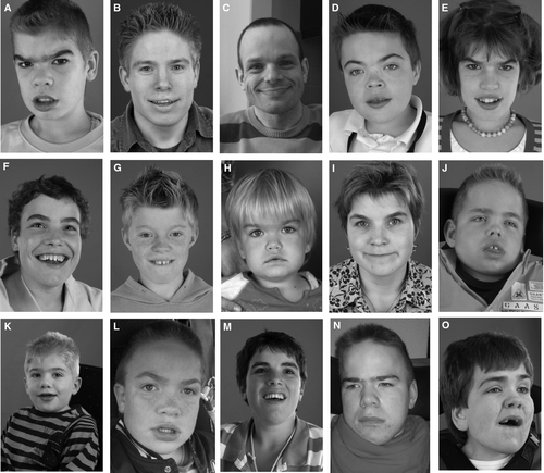 Facies tosca. – Neuropediatoolkit